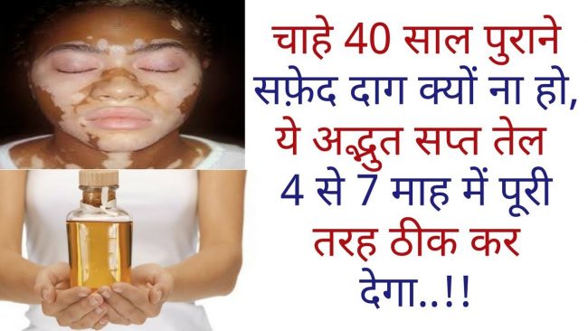 safed daag – Only Ayurved